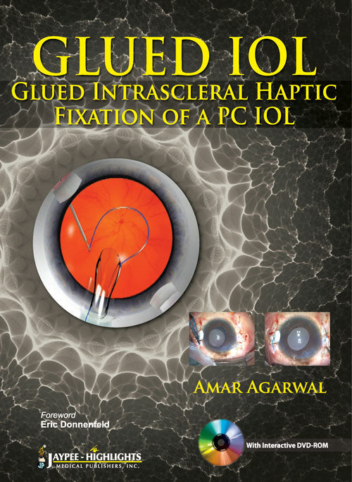 GLUED IOL GLUED INTRASCLERAL HAPTIC FIXATION OF A PC IOL WITH DVD-ROM